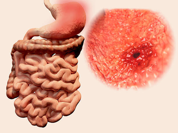 What to Eat When You Have Ulcer and Acid Reflux - 9jaPolyTv